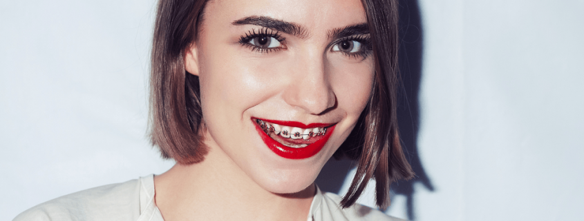 Alineadores o brackets: ¿qué opción es la mejor? - Blog