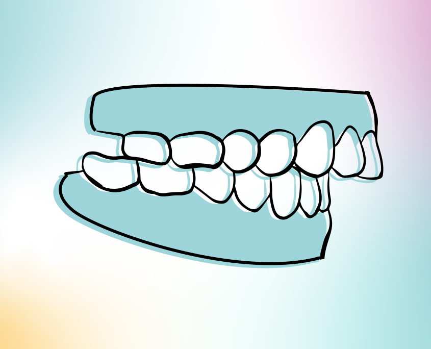 Tipos de mordida: ¿Cuál es la correcta? sMySecret®