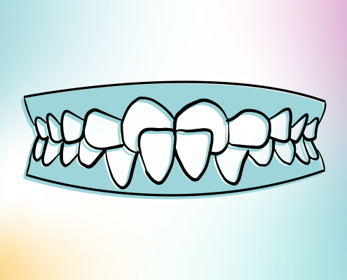Tipos de mordida: ¿Cuál es la correcta? sMySecret®