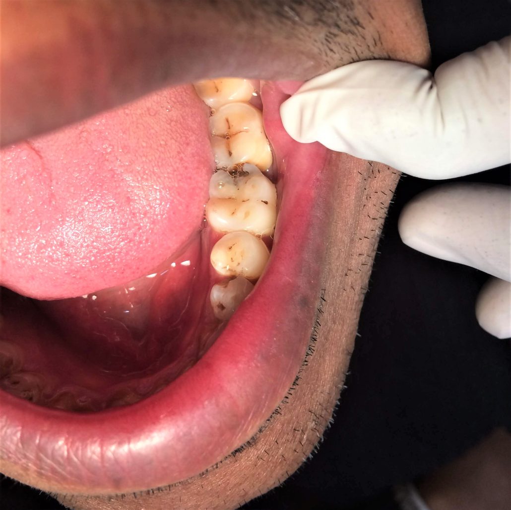 Cómo quitar las caries y cómo prevenirlas | Smysecret Cómo quitar las caries y cómo prevenirlas | Smysecret