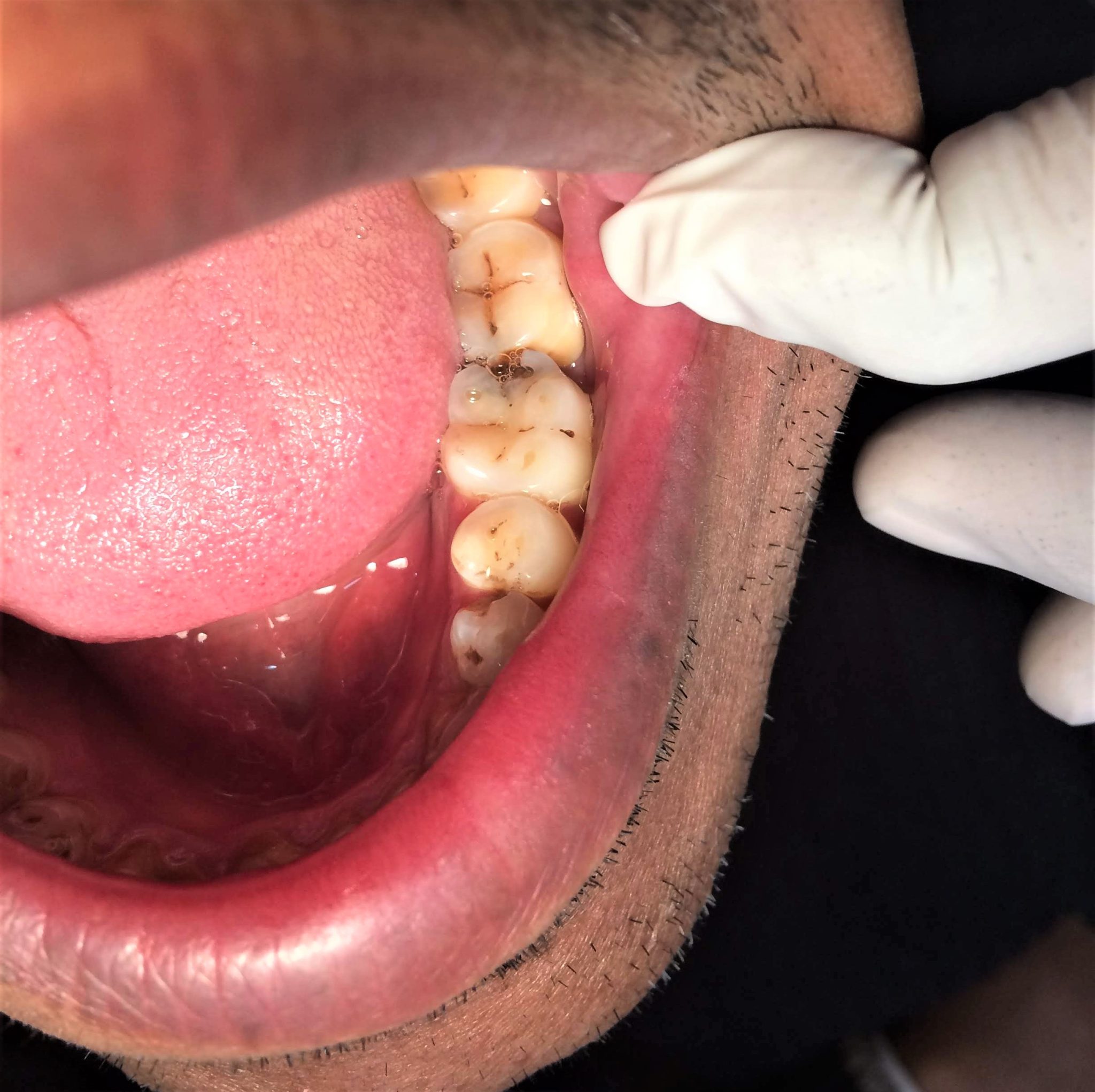 Cómo quitar las caries y cómo prevenirlas | Smysecret