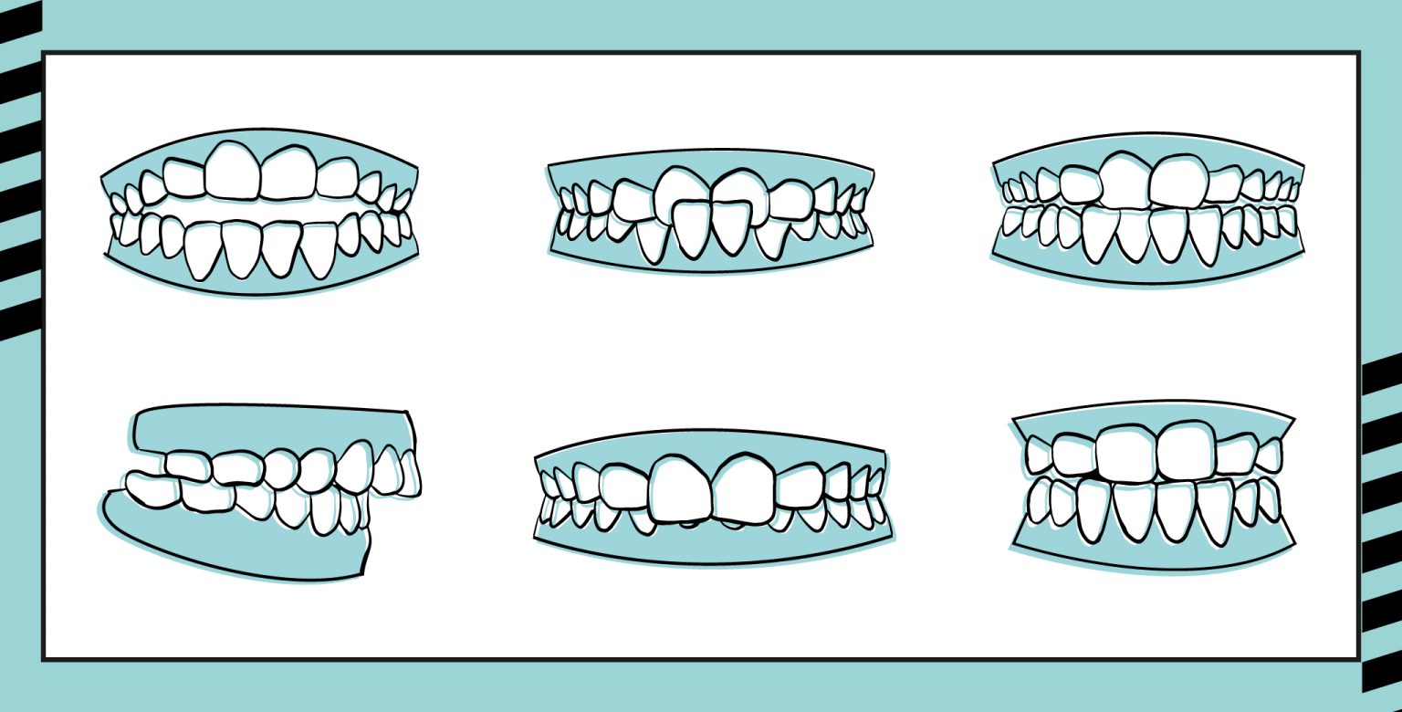 Cómo corregir una maloclusión dental fácilmente | Smysecret